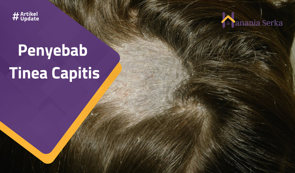 Penyebab Tinea Capitis | Hanania Serka