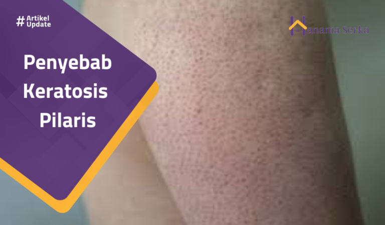 Penyebab Keratosis Pilaris Hanania Serka