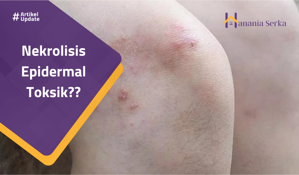 Nekrolisis Epidermal Toksik?? | Hanania Serka