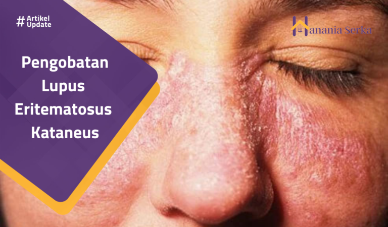 Pengobatan Lupus Eritematosus Kataneus | Hanania Serka