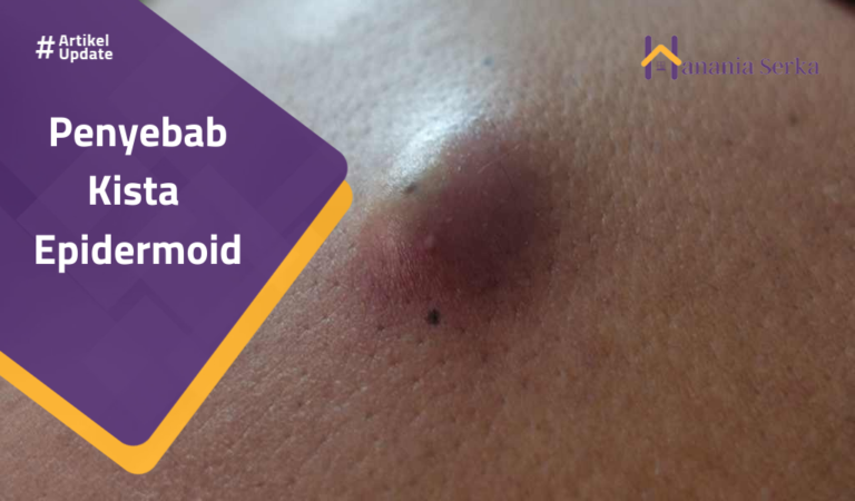 Penyebab Kista Epidermoid | Hanania Serka