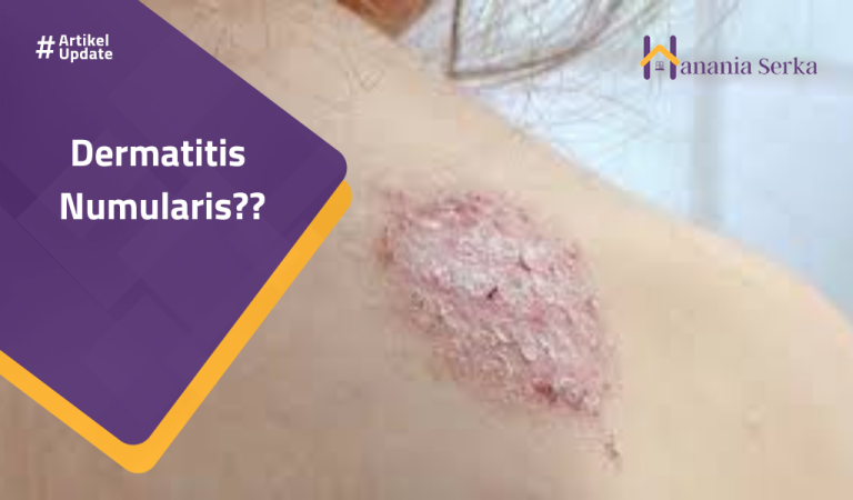 Dermatitis Numularis?? | Hanania Serka